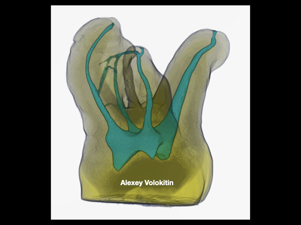 Dental News - Clinical management of maxillary second molar root canal ...