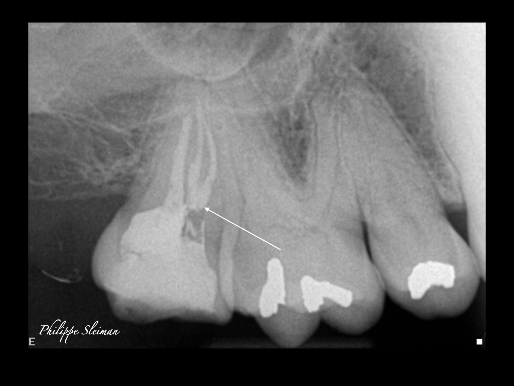 Dental News - Clinical management of maxillary second molar root canal ...