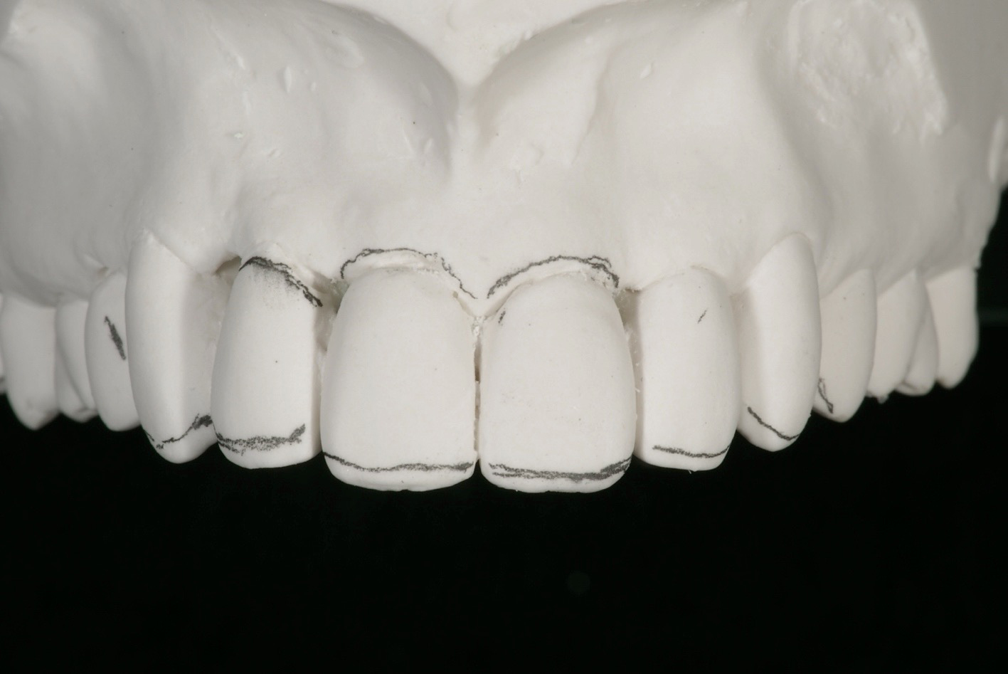 Buccal root of the bifurcated maxillary premolar—a danger zone during ...