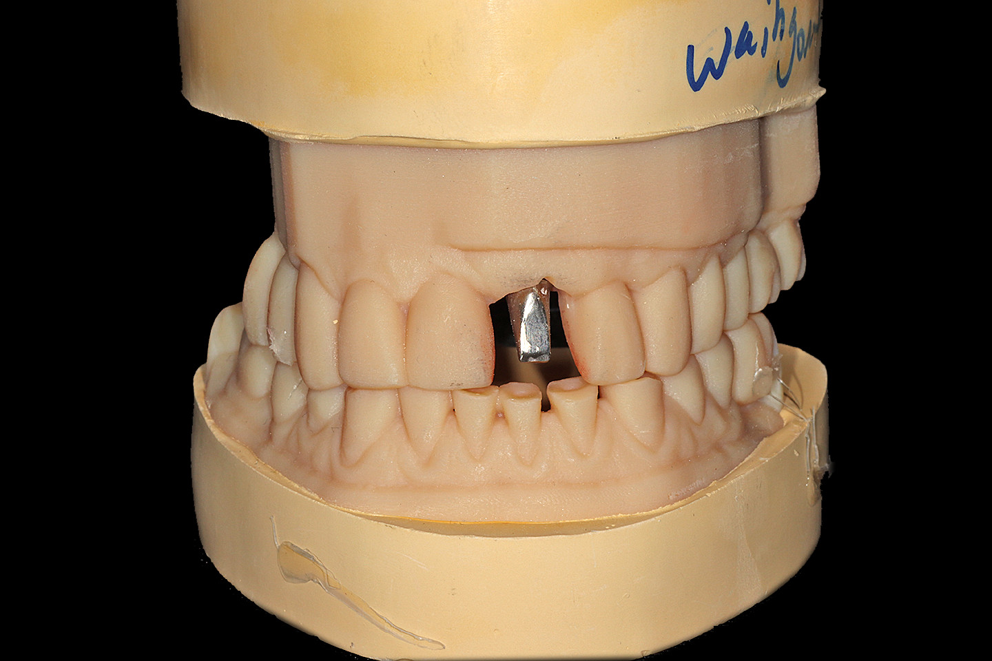 Dental News - Guided applications for partial extraction therapy