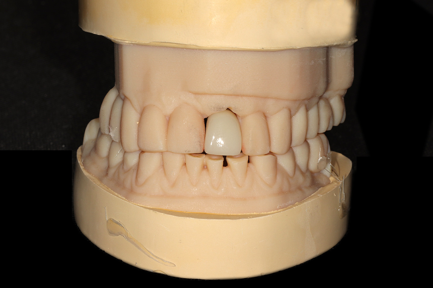 Guided applications for partial extraction therapy