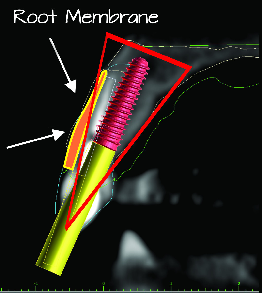 Dental News - Guided applications for partial extraction therapy