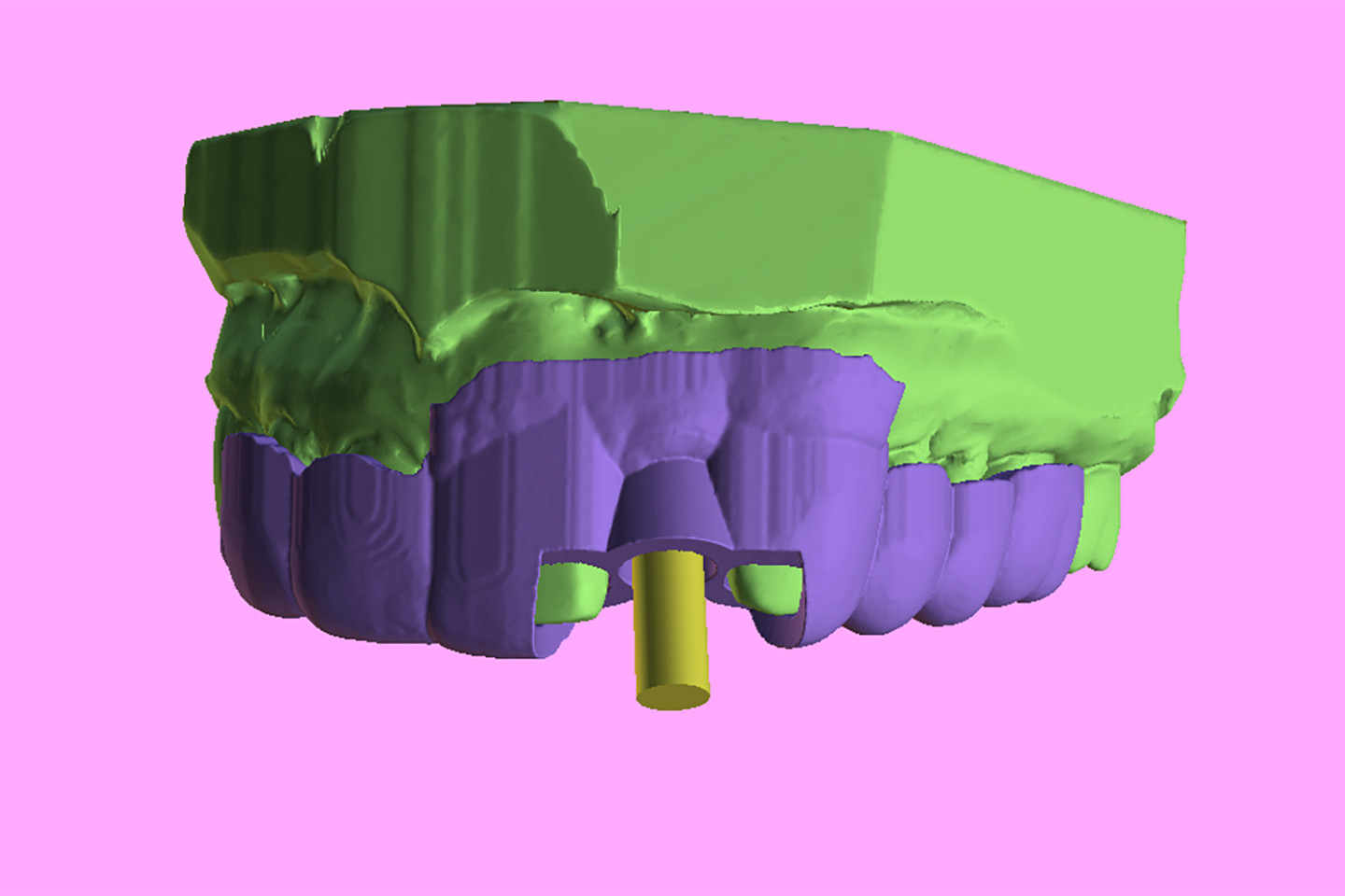 Dental News - Guided applications for partial extraction therapy