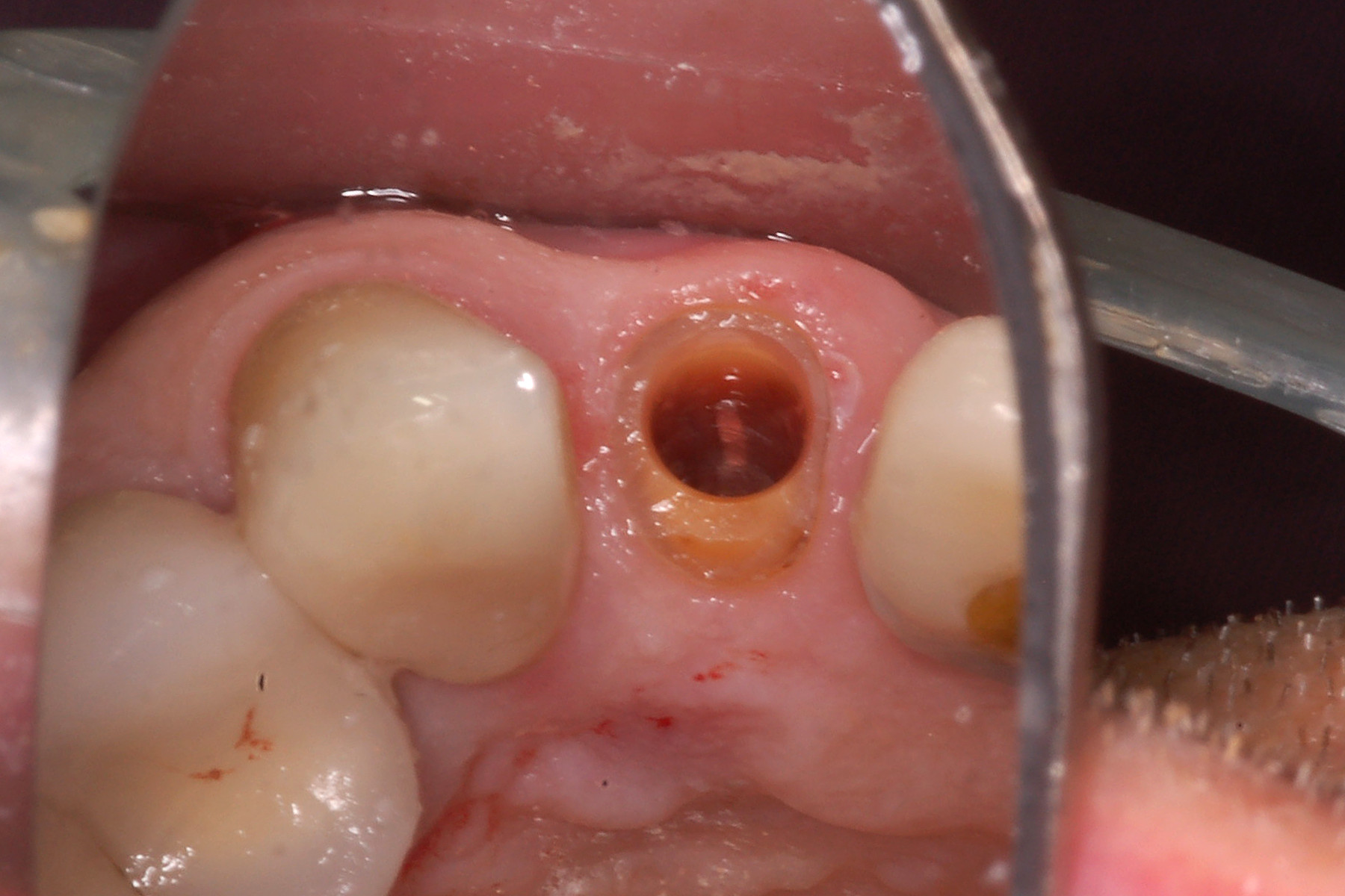 Dental News - Guided applications for partial extraction therapy