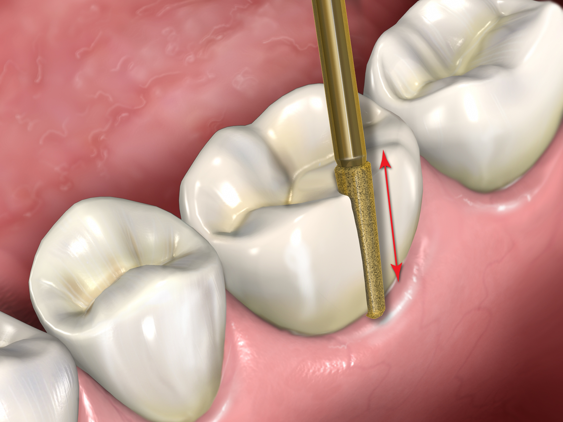Eliminating the challenges of crown removal or endodontic access ...