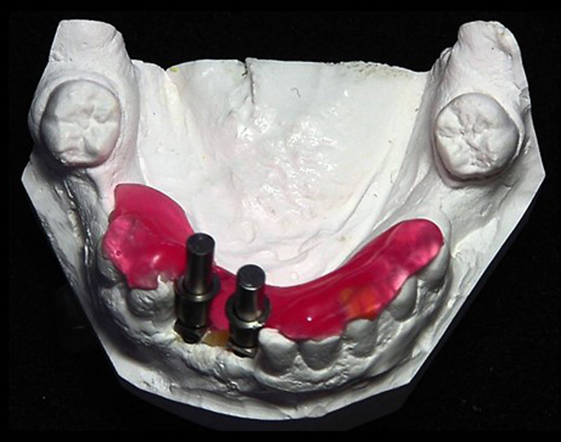 An in-office-fabricated implant surgical guide corrected using CBCT