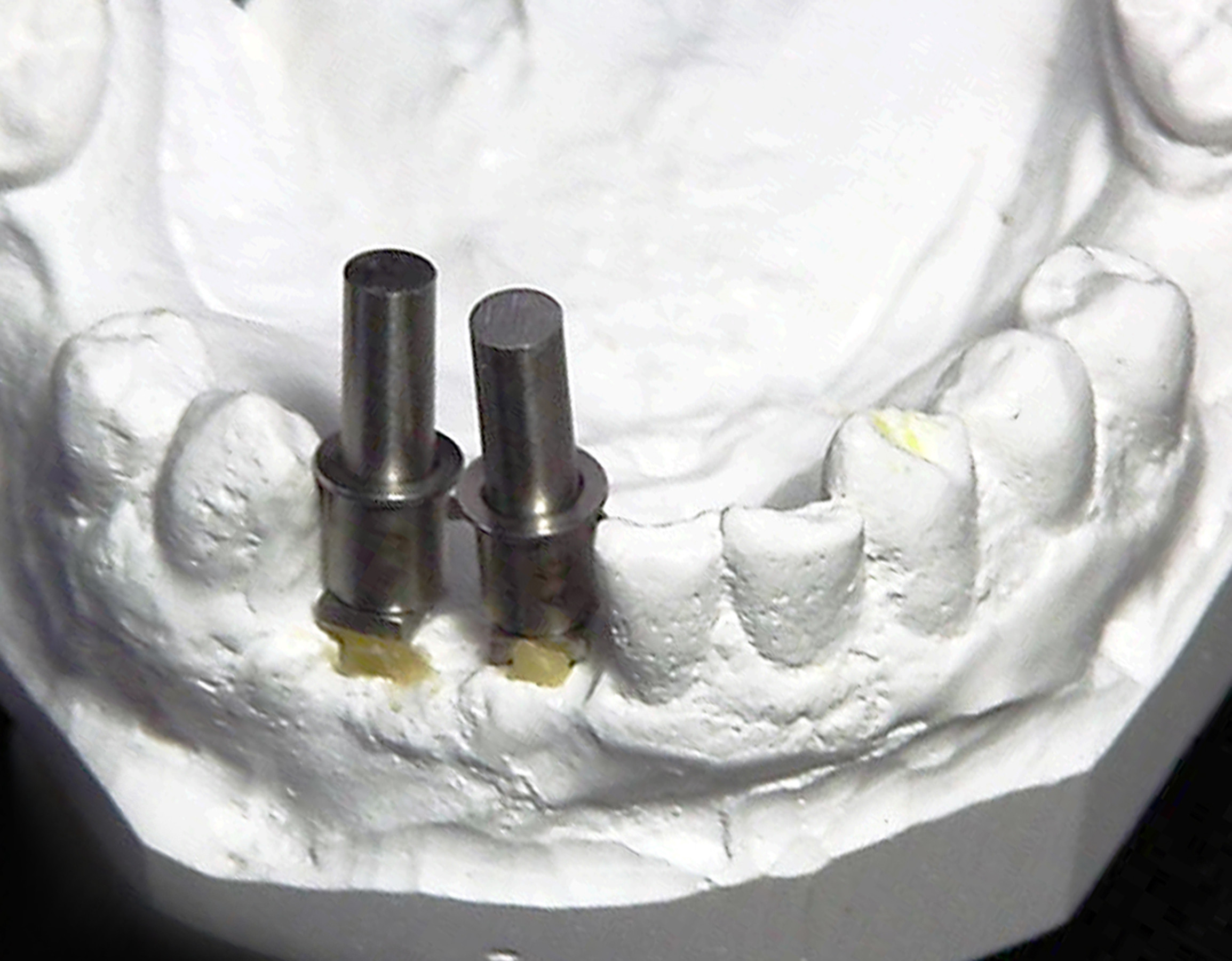 An in-office-fabricated implant surgical guide corrected using CBCT
