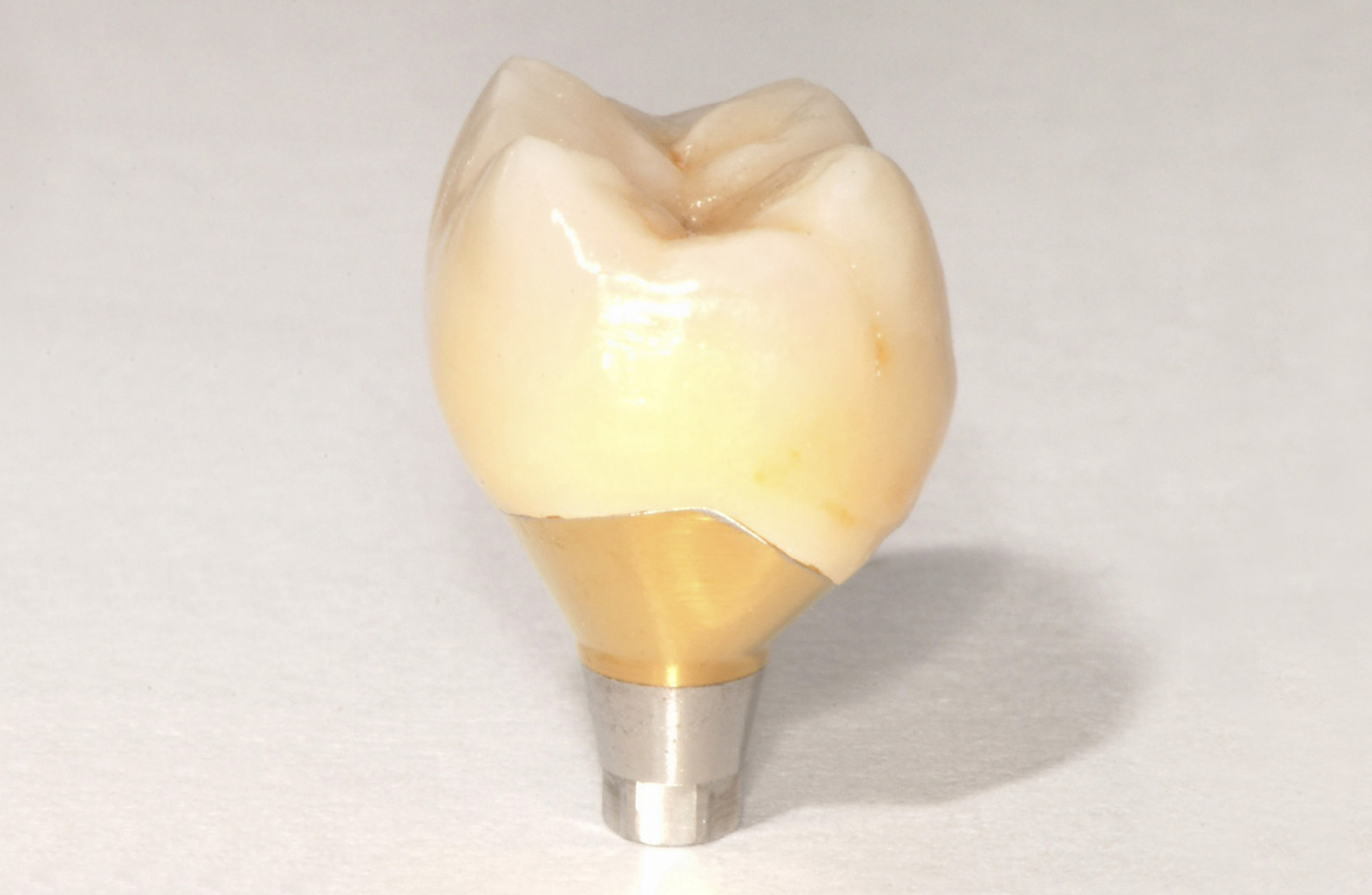 Dental News - Achieving anatomical shape, support and colour with an ...