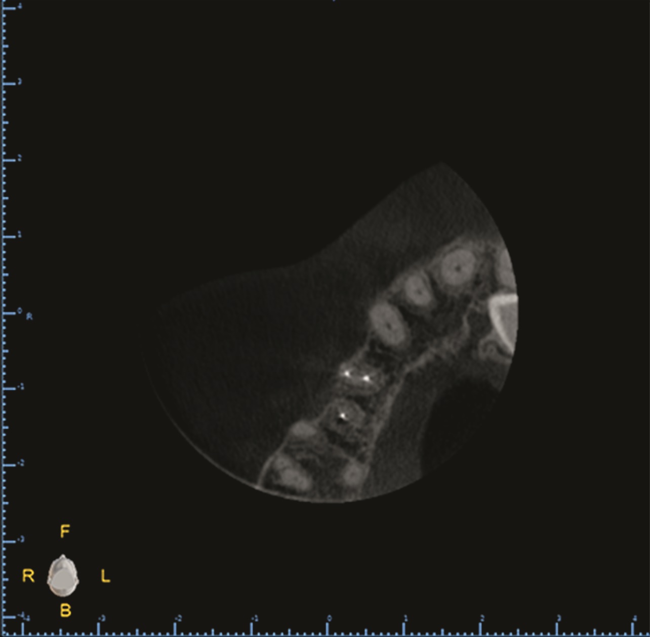 Target endodontic microsurgery