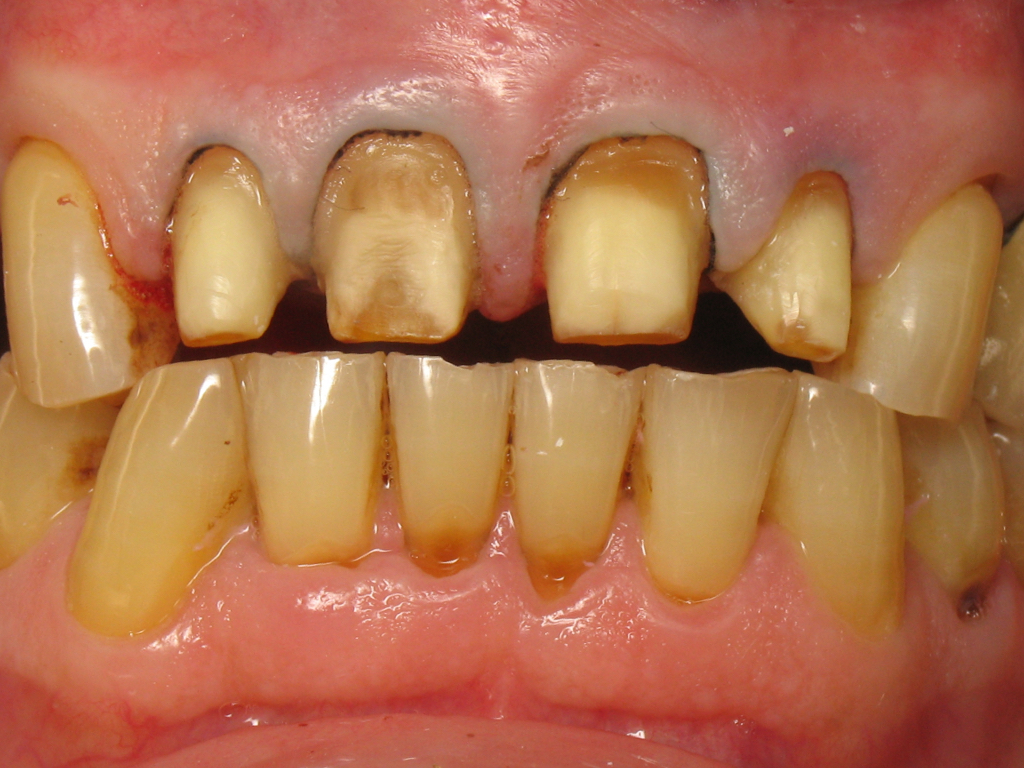 Tenet: Time inversion applied to dentistry