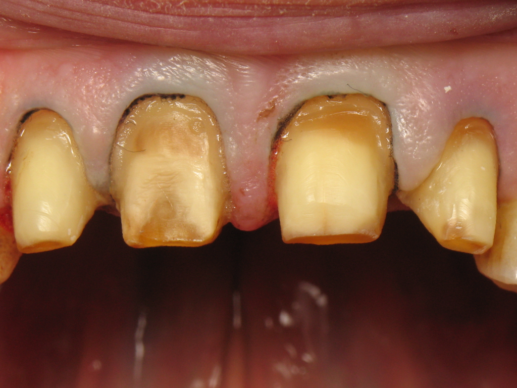 Tenet: Time inversion applied to dentistry
