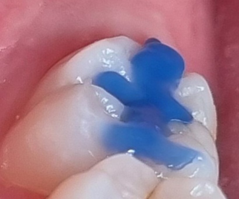 Dental News - The stamp technique: Quick and effective restoration with ...