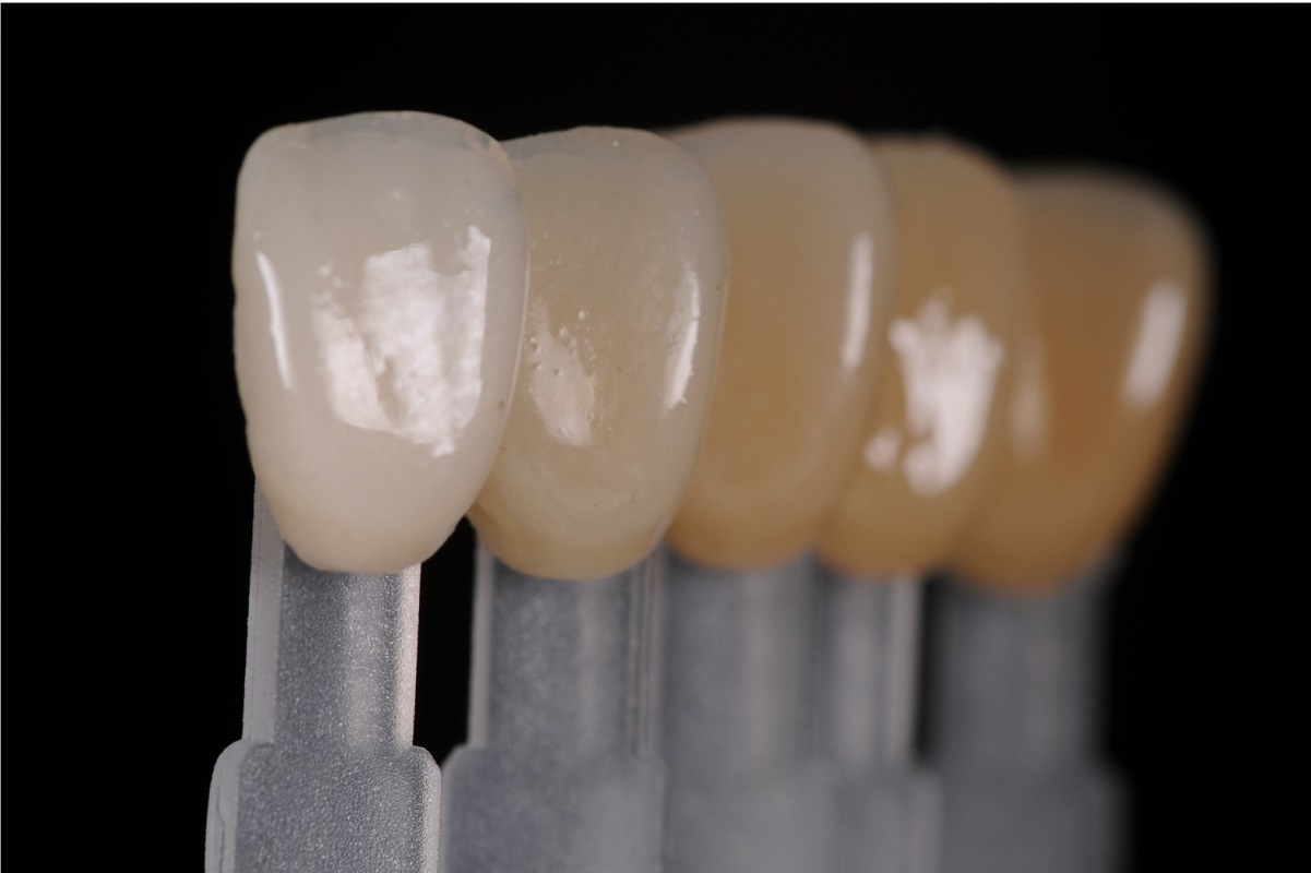 Digital dental shade measurement