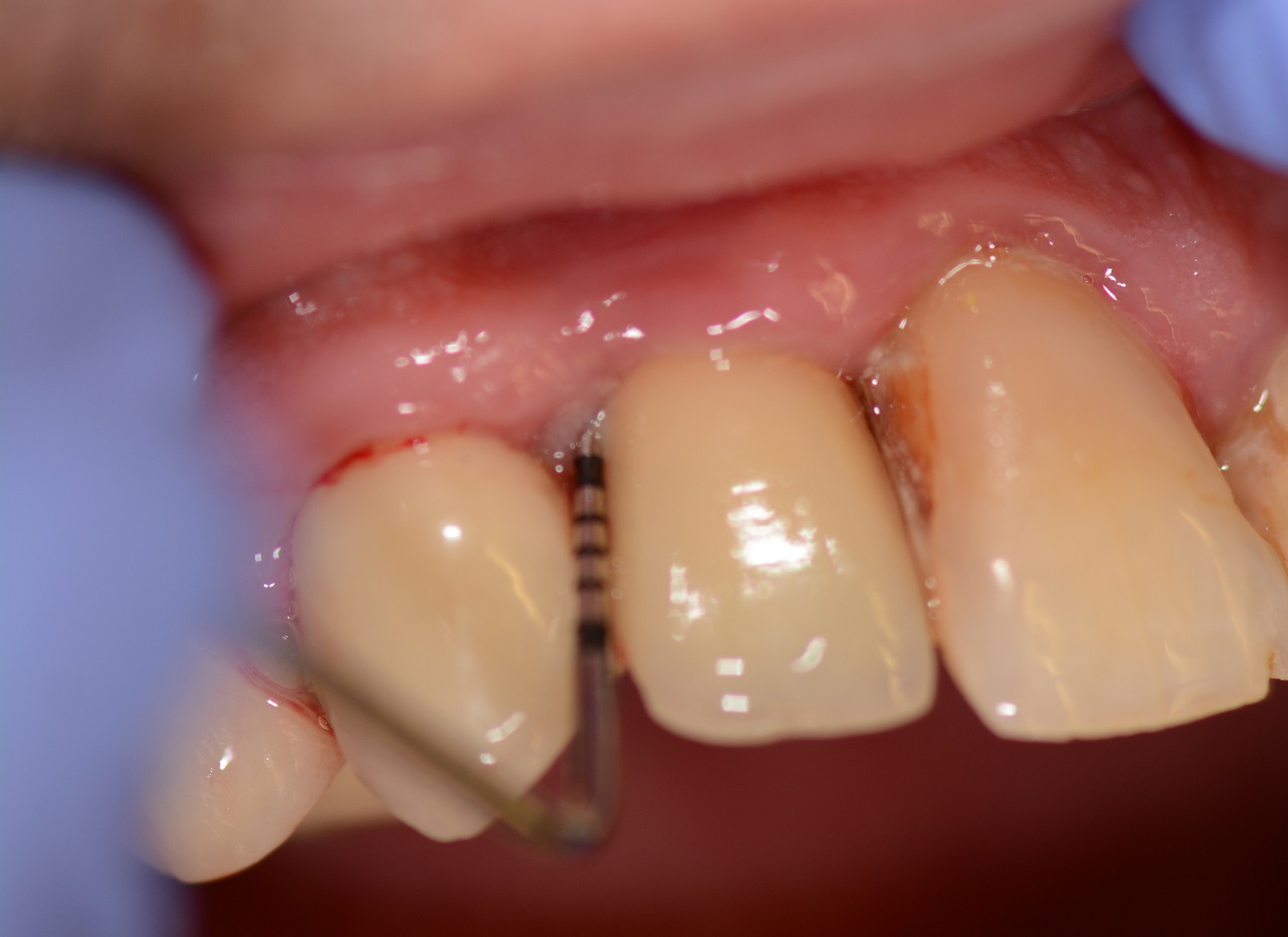 Dental News - Interview: Laser protocol for peri-implantitis treatment