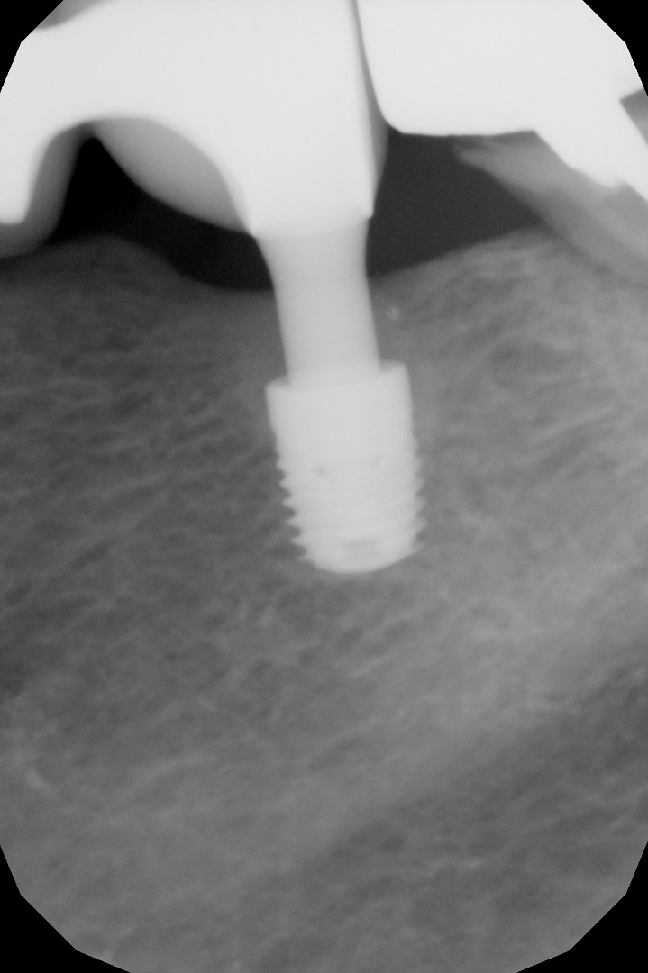 Dental News - Prosthetic rehabilitation with short GTB implants: A case ...