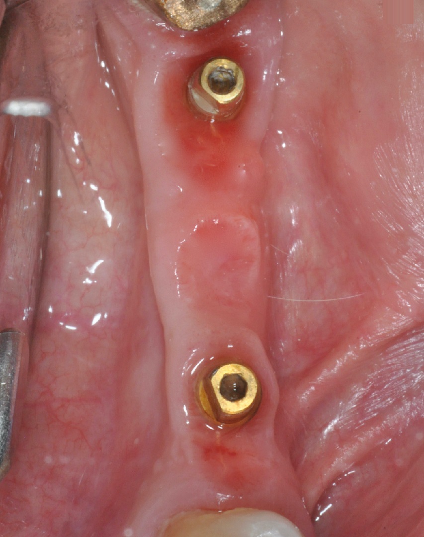 Dental News - Prosthetic rehabilitation with short GTB implants: A case ...