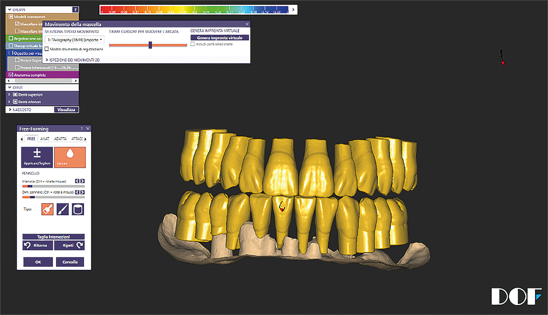 Production of complete maxillary and mandibular dentures using CAD/CAM ...