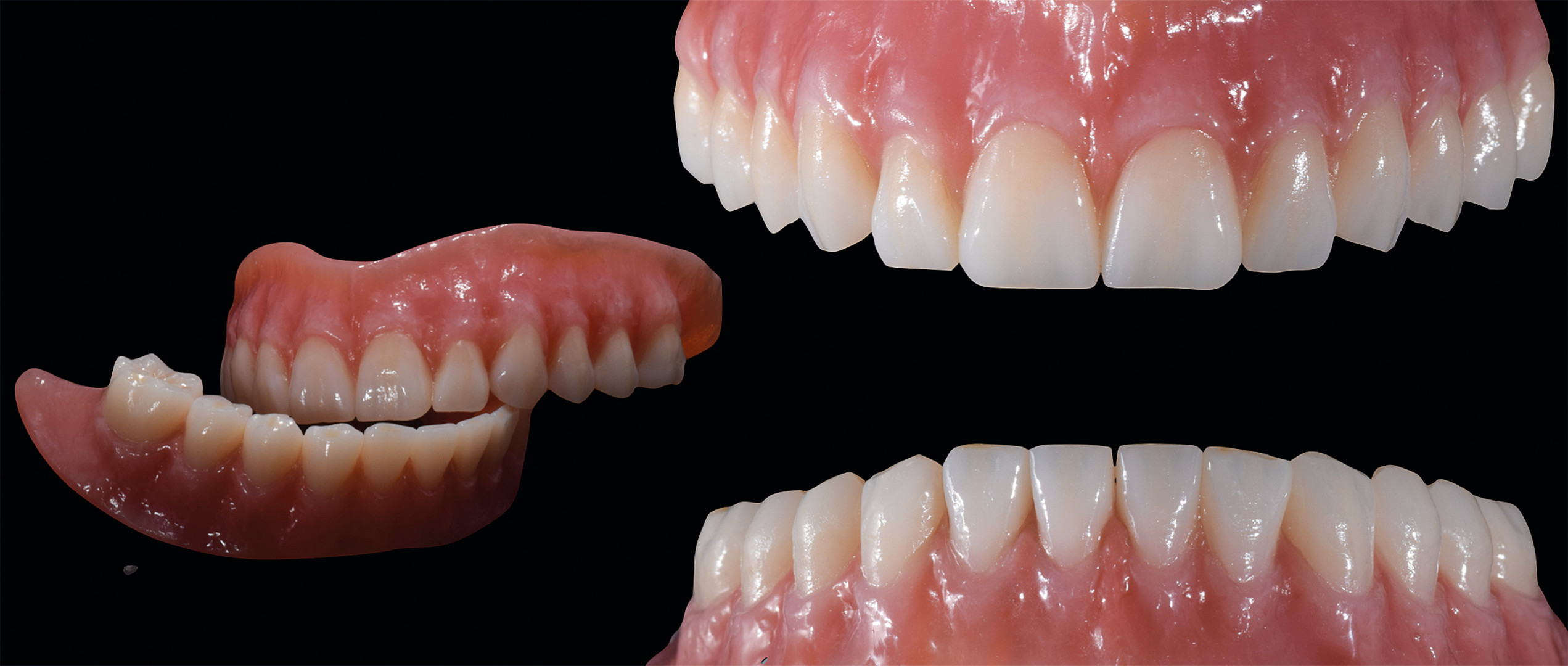 Production of complete maxillary and mandibular dentures using CAD/CAM ...
