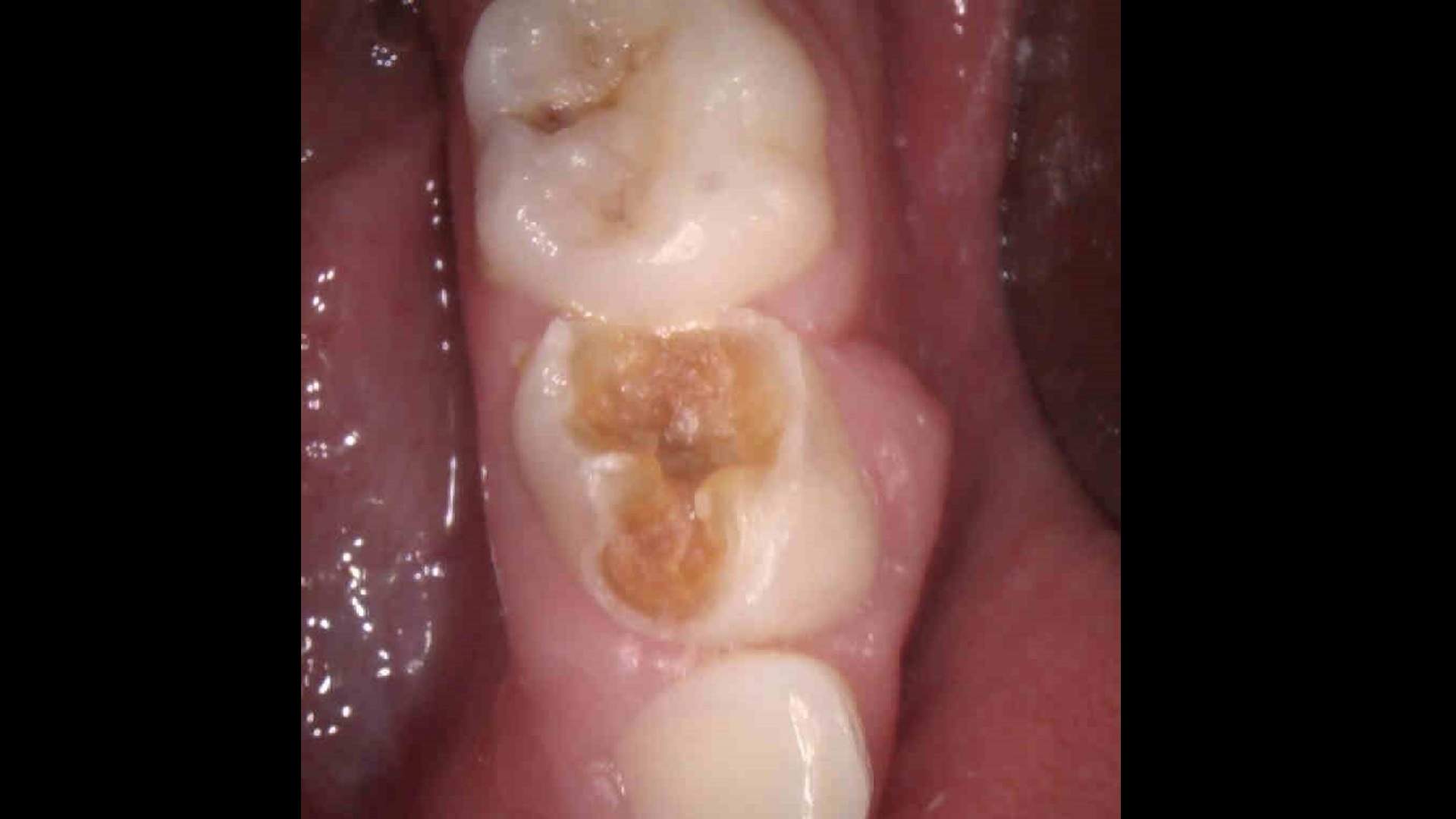 Root canal therapy of necrotic primary molars—using a single-file ...