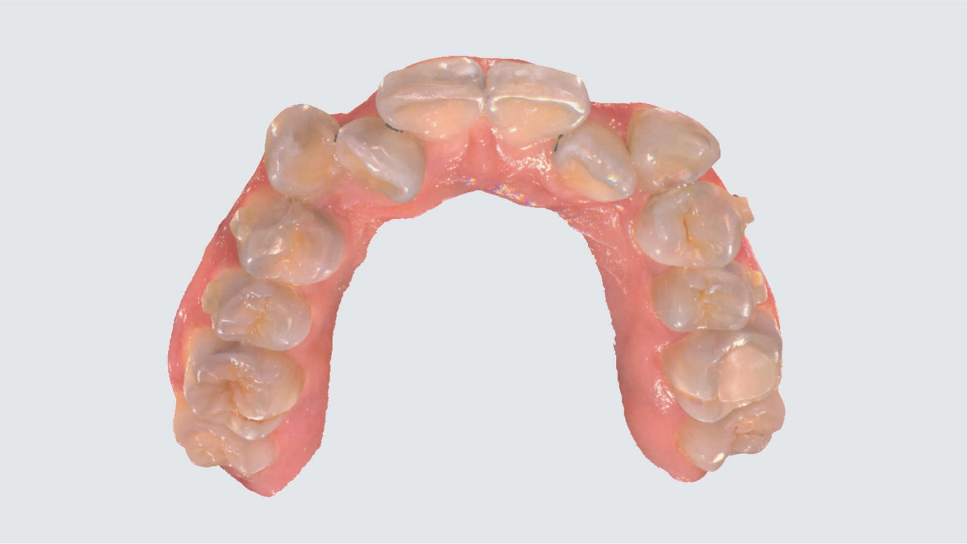 DT News - Latin America - Lo que debes saber sobre los escáneres intraorales (2)