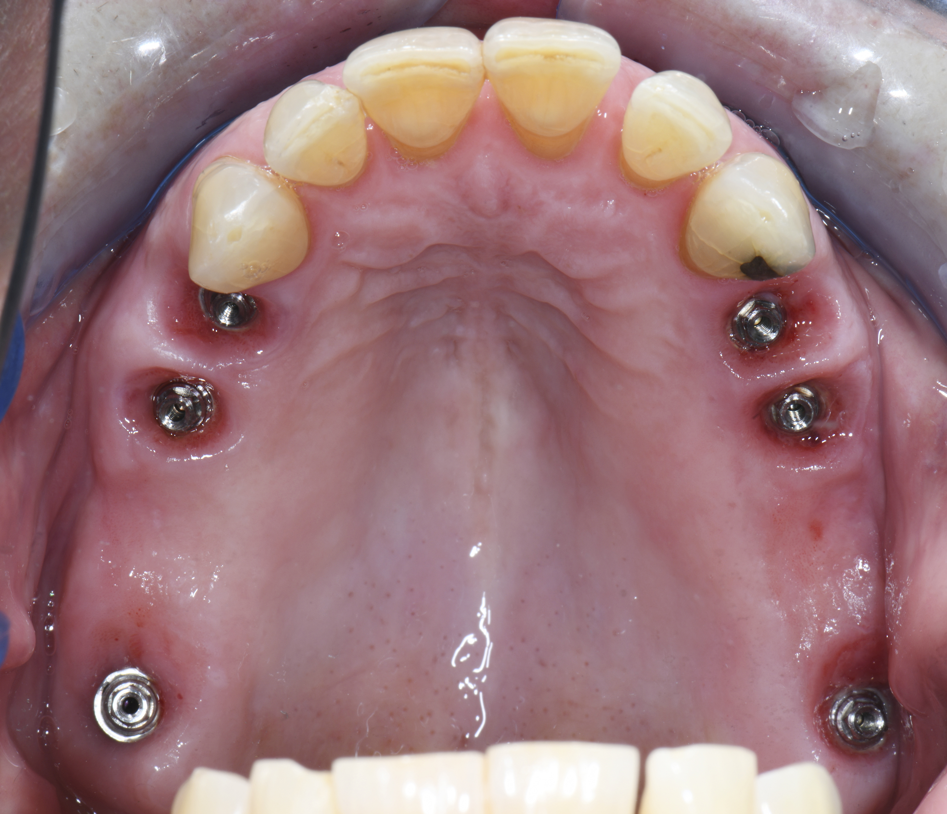 Immediate loading of the posterior maxilla